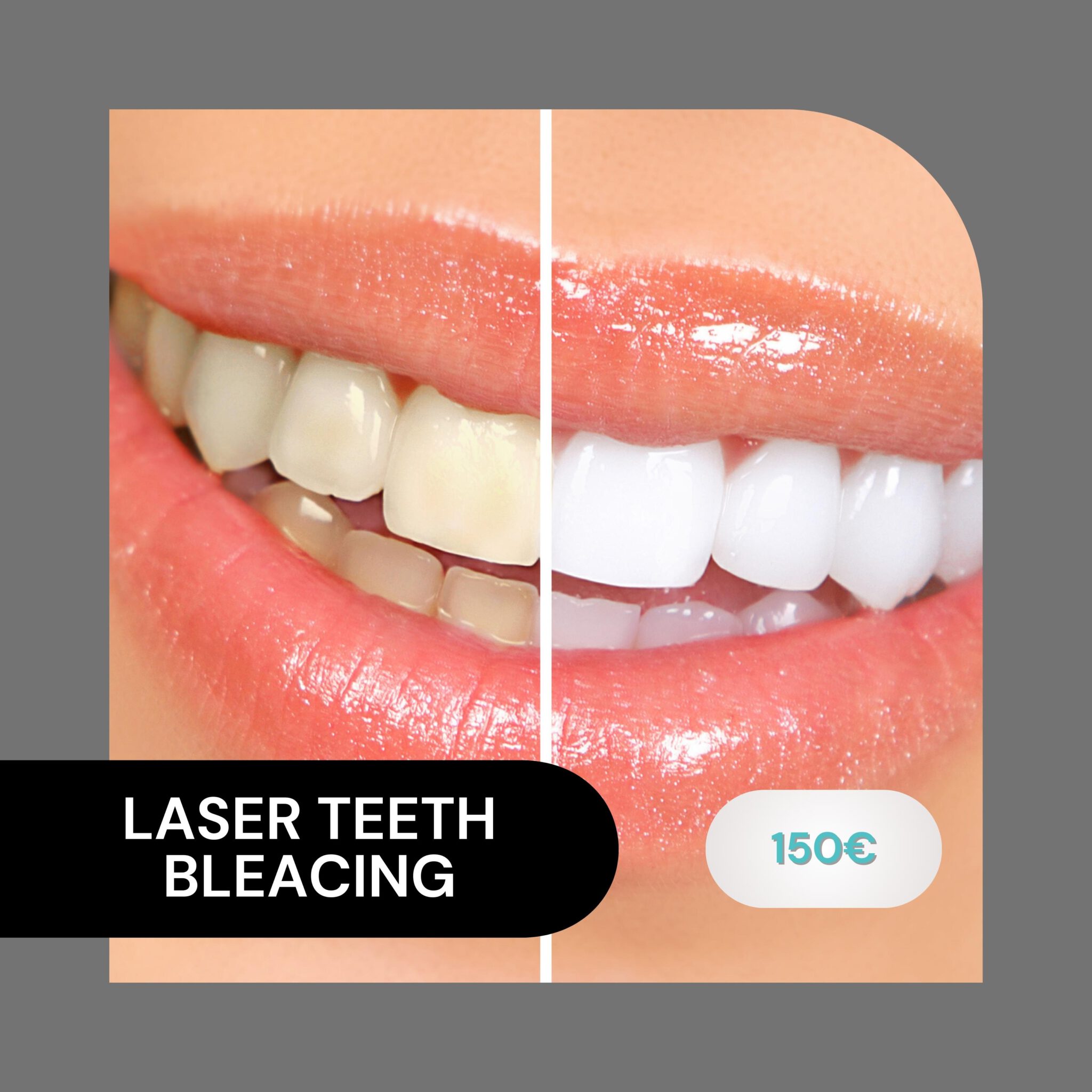 Laser Teeth Bleaching – Smile in Turkey
